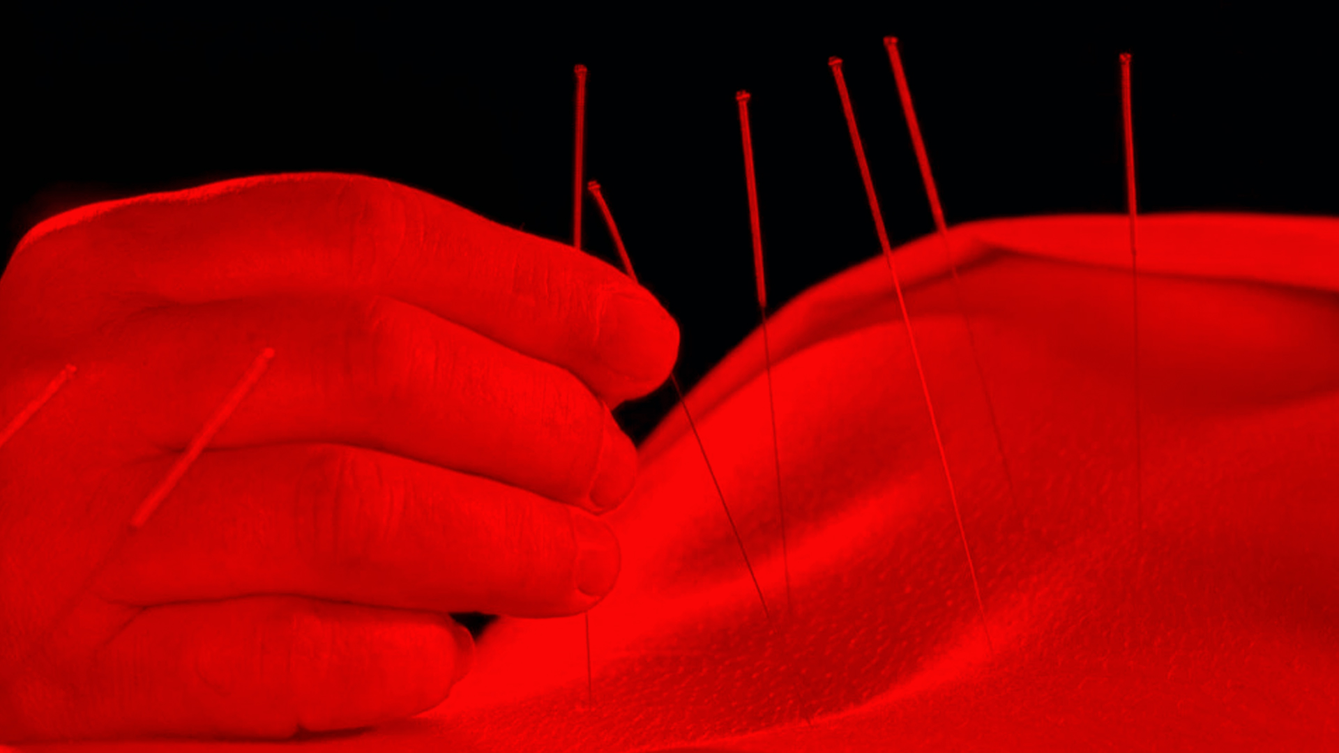 Acupuncture [1 time] | PULSE CLINIC - Asia's Leading Sexual Healthcare ...